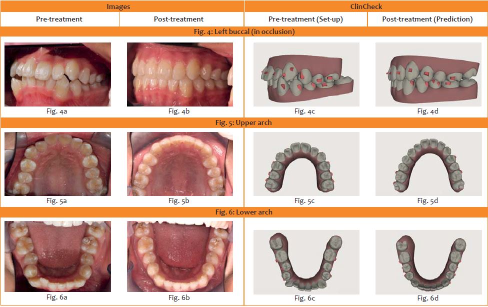 The Potential of Invisalign II - Imperial Dental Specialist Centre